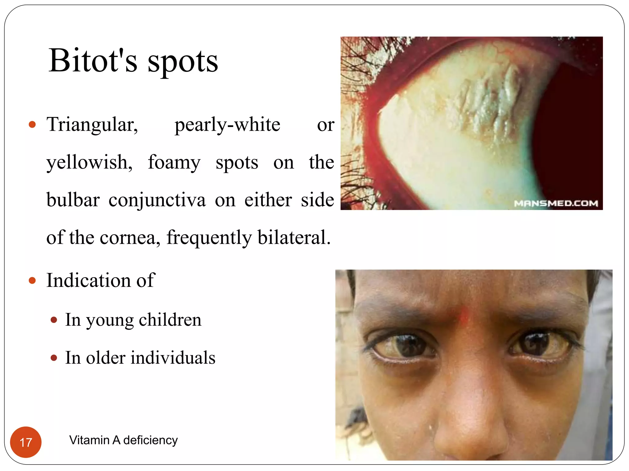 Vitamin A deficiency | PPTX