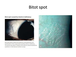 Vitamin A Deficiency.pptx