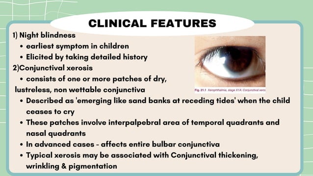 Xerophthalmia in vitamin A deficiency.pdf