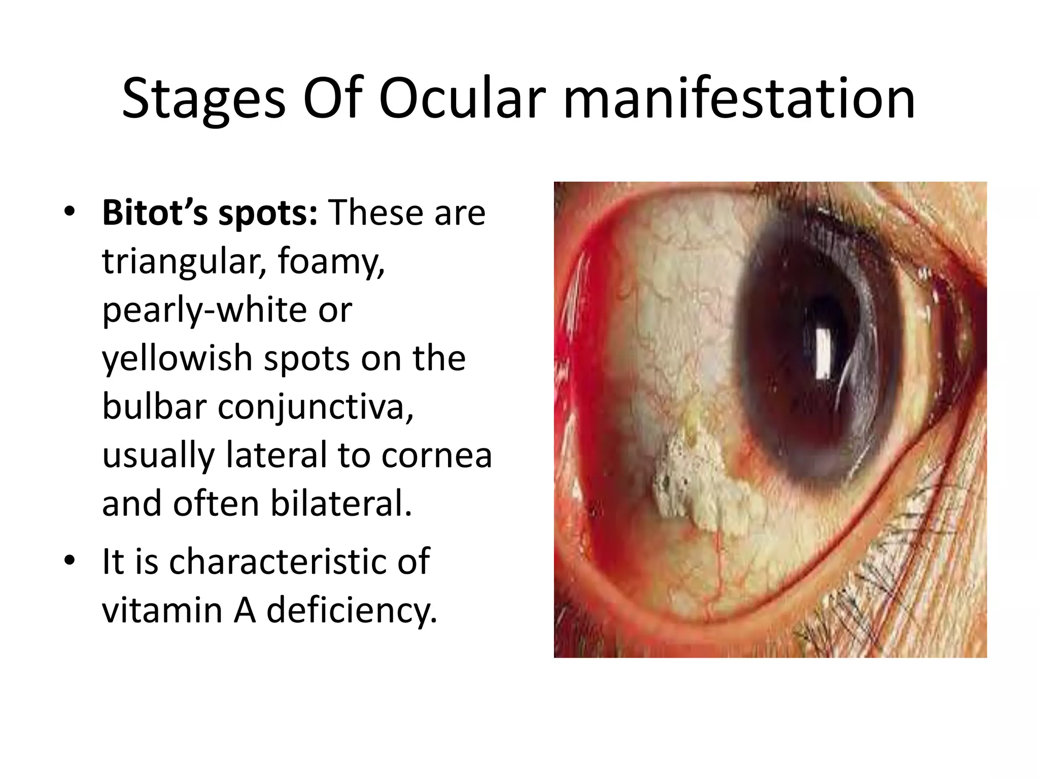 Vitamin A deficiency and control programme | PPTX