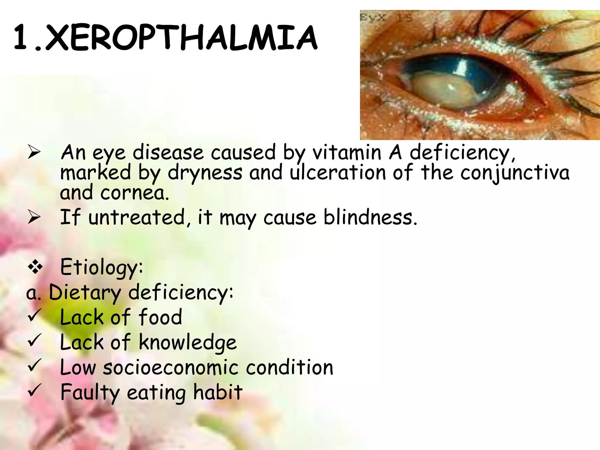 Vitamin a deficiency disorder | PPTX