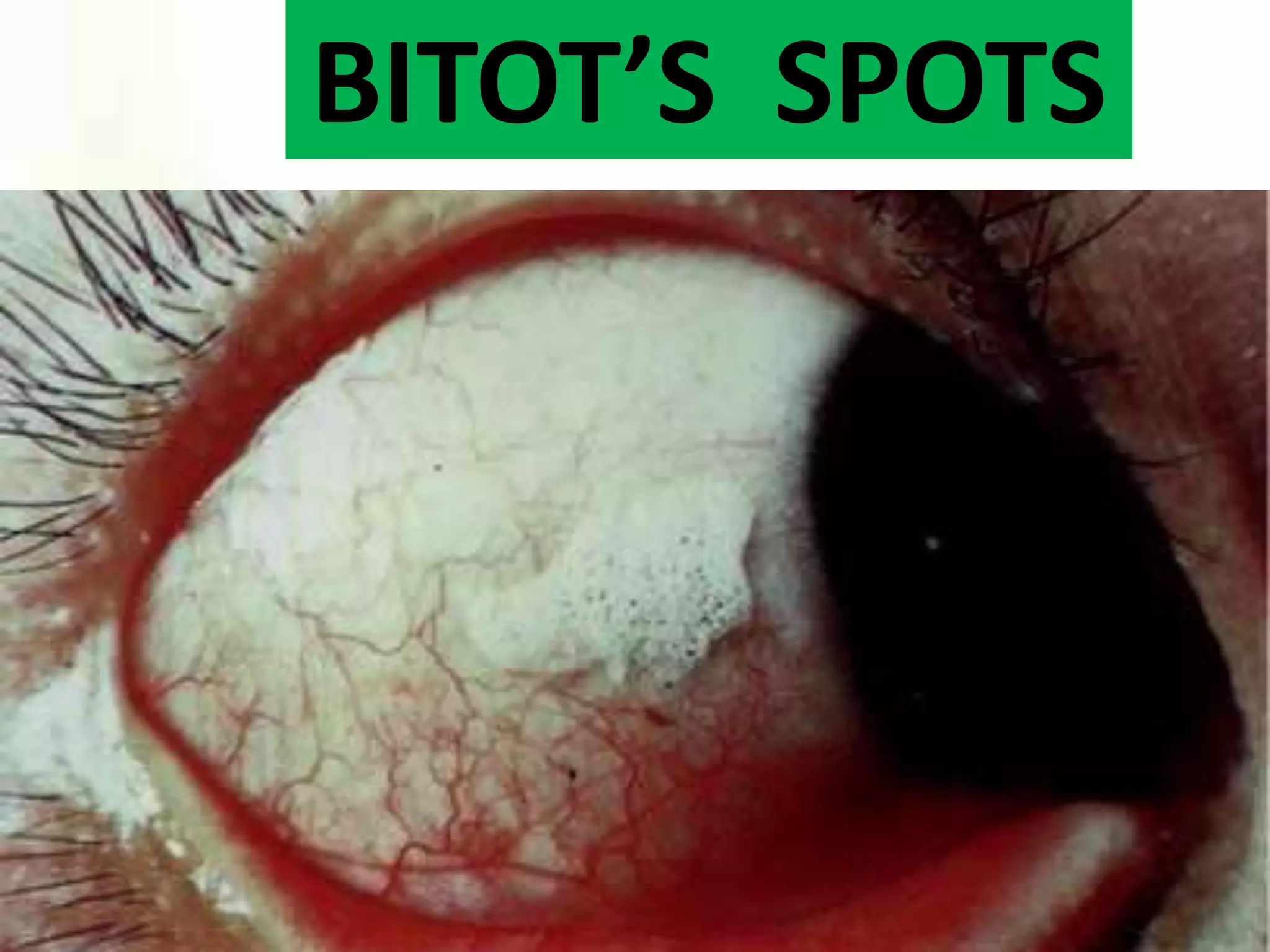 Vitamin a deficiency disorder | PPTX