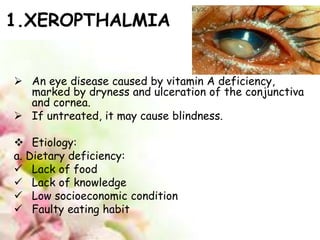 Vitamin a deficiency disorder | PPTX