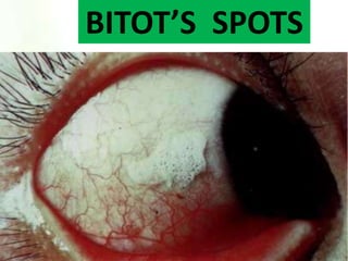 Vitamin a deficiency disorder | PPTX