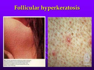 Follicular Hyperkeratosis Vitamin A Deficiency