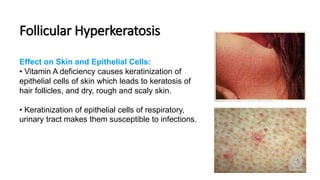 Follicular Hyperkeratosis Vitamin A Deficiency