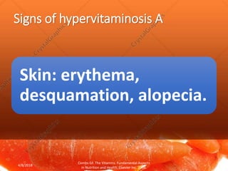 Vitamin A toxicity | PPSX