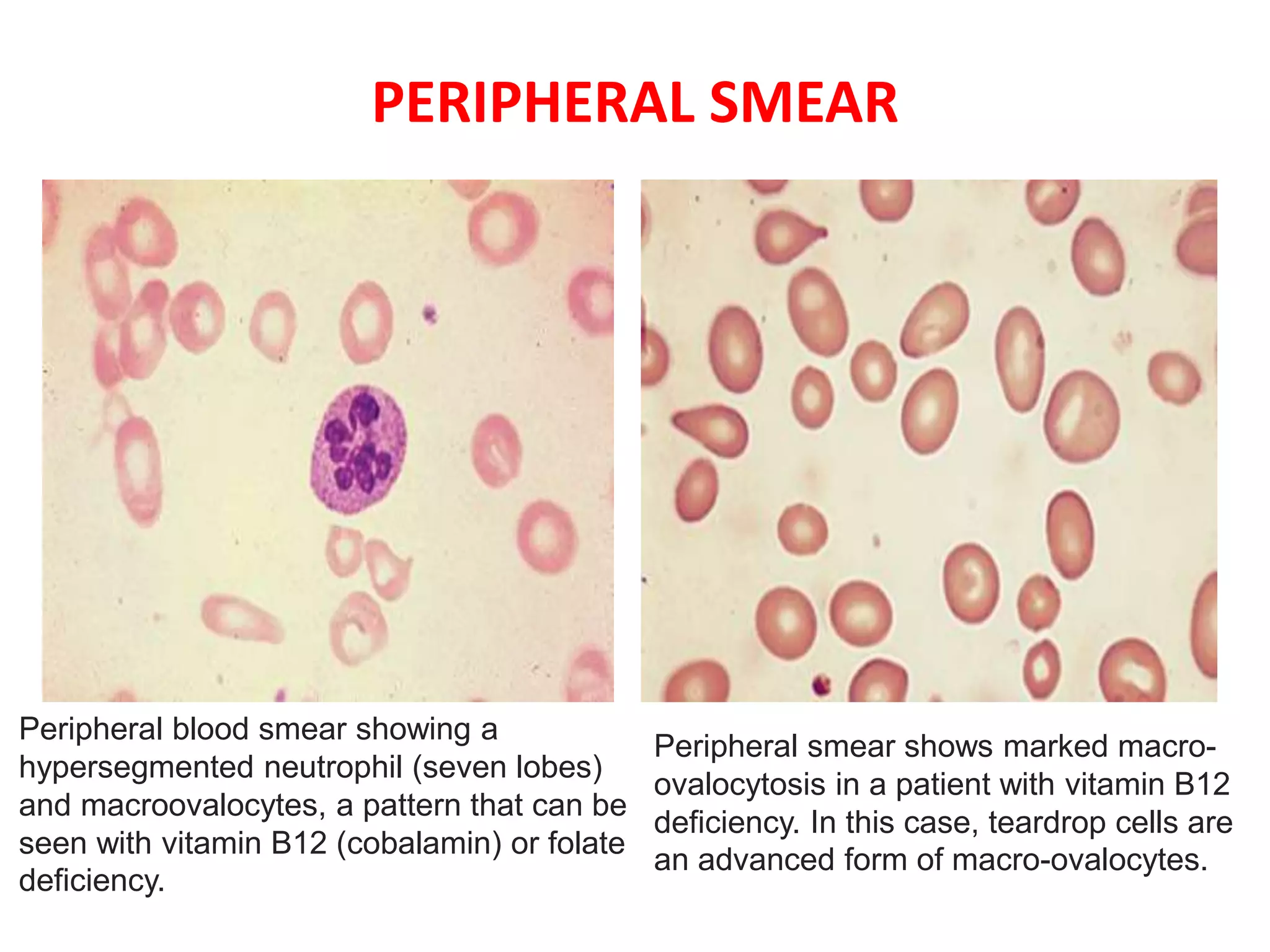vitamin b12 deficiency.pptx