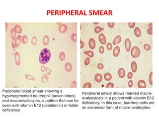 vitamin b12 deficiency.pptx