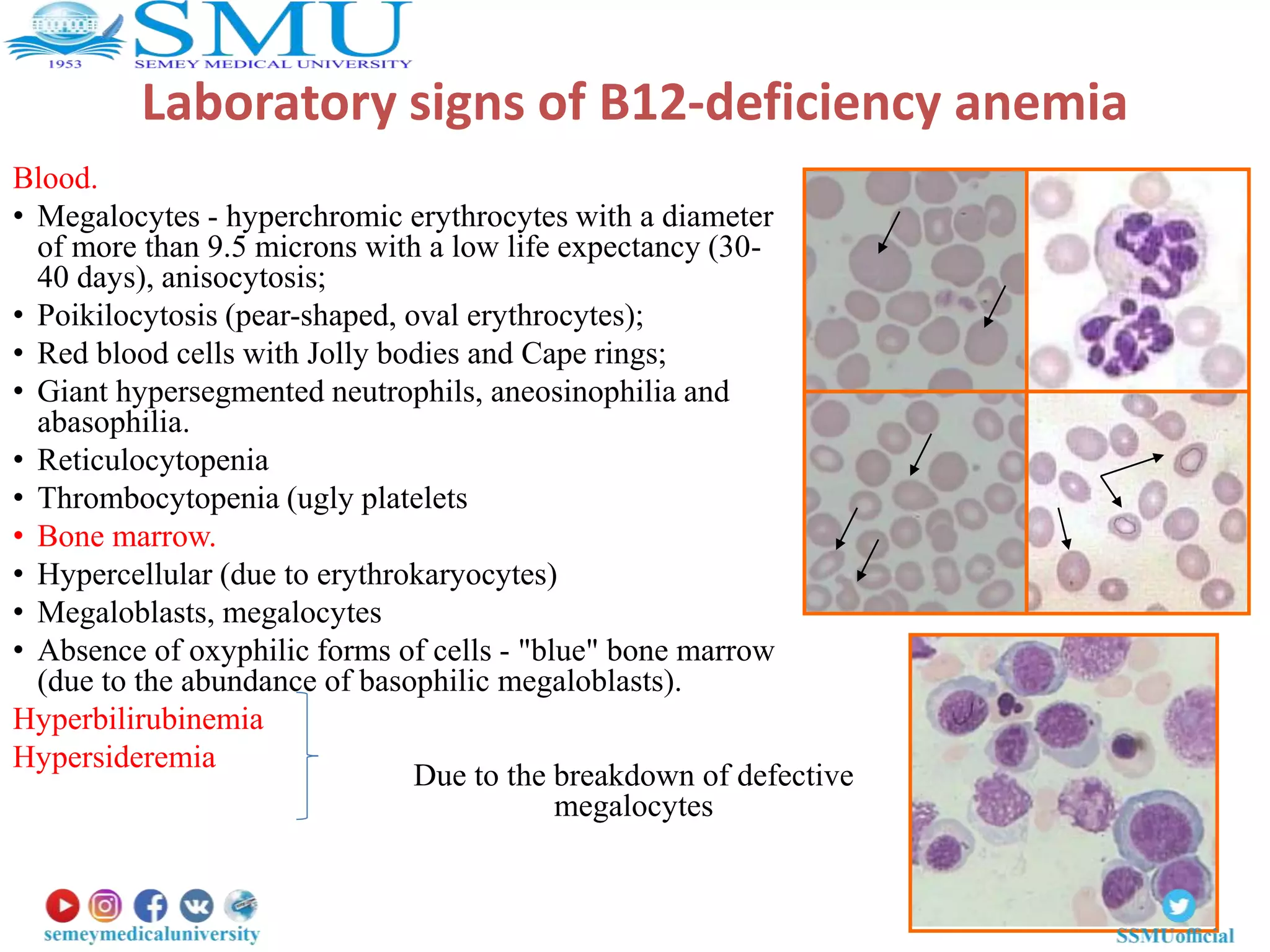 Vitamin B12 deficiency anemia (B12-DA),PPT. eng.pptx