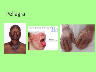 Vitamin B3 deficiency | PPTX | Nutrition | Healthy Living