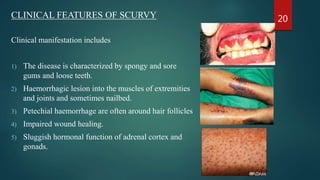 Vitamin C and Periodontal Health | PPTX