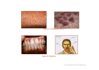 vitamin C deficiency, scurvy and other.pptx