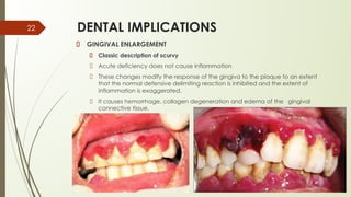 Role of Vitamin C in Periodontal Diseases | PDF
