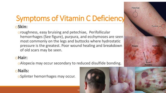 Vitamin c deficiency disorders | PPTX | Blood Disorders | Diseases and ...