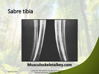 Vitamin D deficiency | PPSX