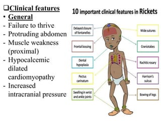 Rickets | PPTX | Bone and Joint Conditions | Diseases and Conditions