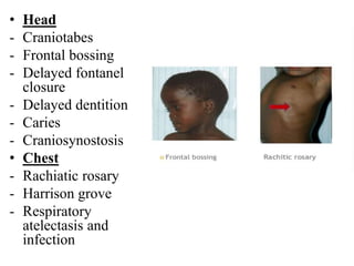Rickets | PPTX | Bone and Joint Conditions | Diseases and Conditions