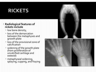 Vitamin d dosing protocol for pediatrics jan 2017 | PPTX | Bone and ...