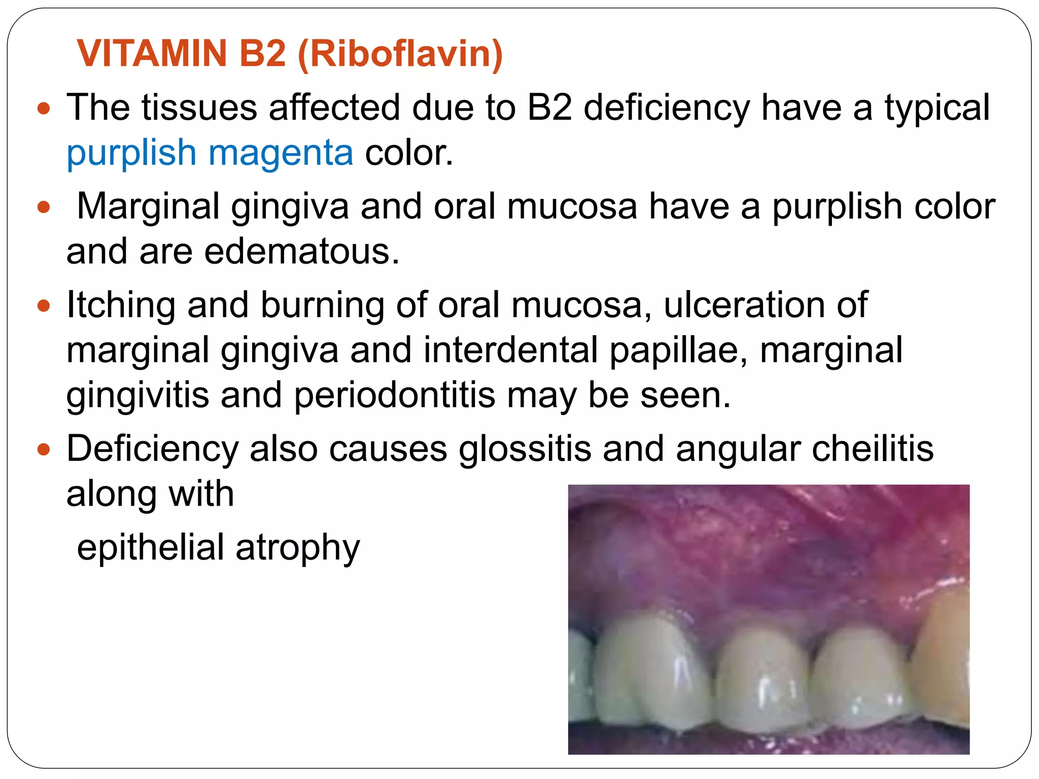Vitamin deficiency and periodontal disease – a tie | PPTX