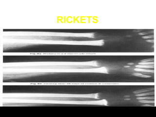 Vitamin deficiency disorder | PDF