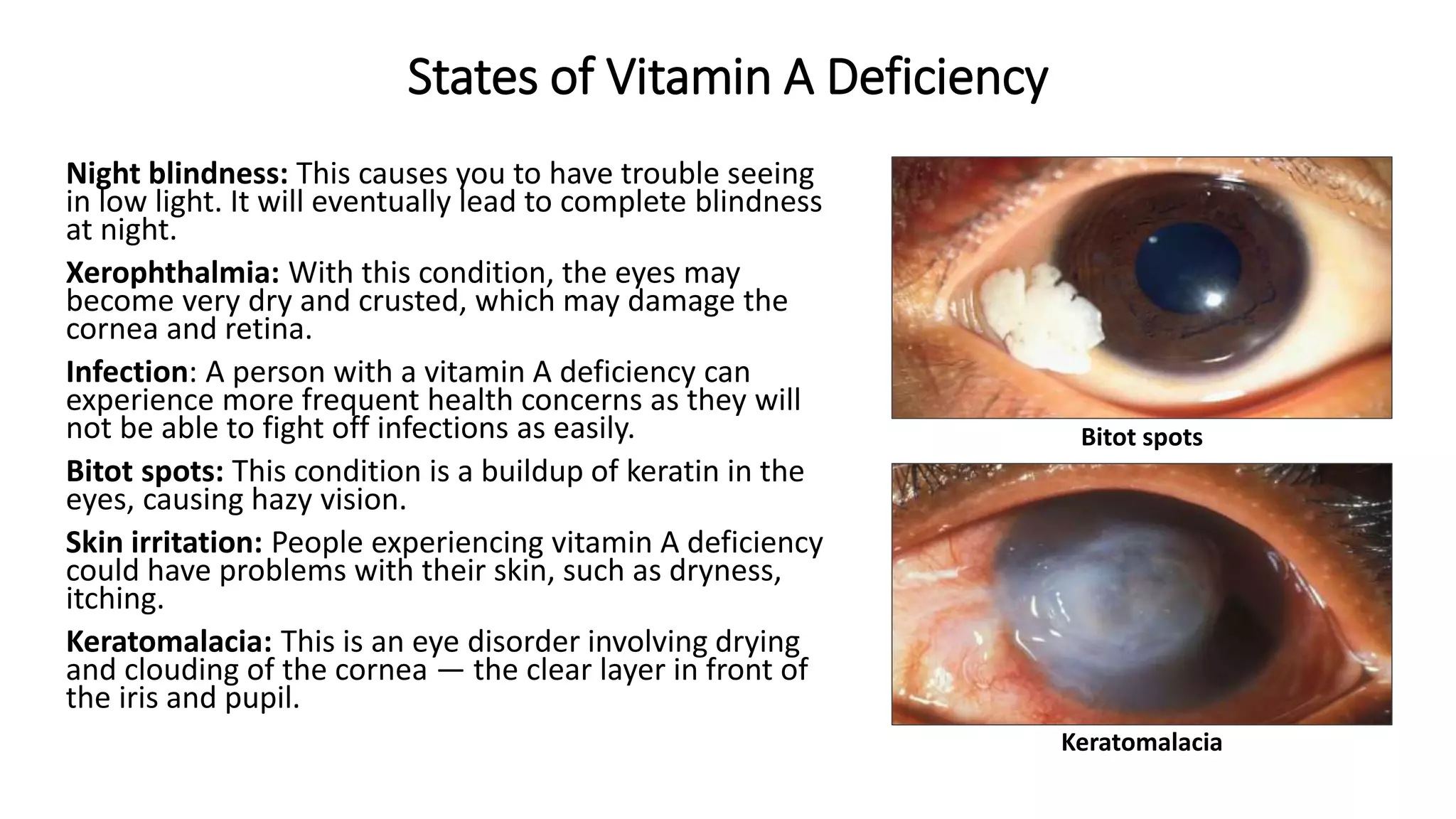 Deficiency States of Vitamins Such as A, C and D.pptx