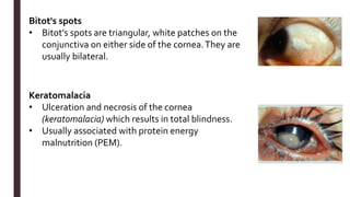 Vitamins adek | PPTX