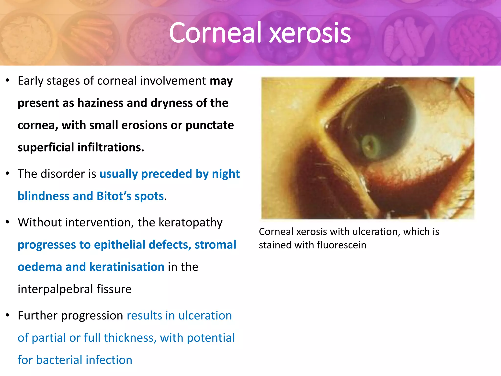Vitamins and eye | PDF