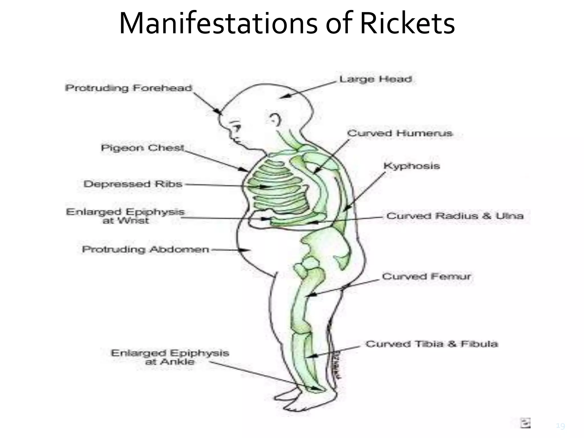 Vitamins & deficiency diseases | PPTX