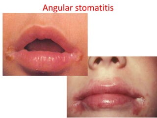 VITAMINS (Water soluble).ppt