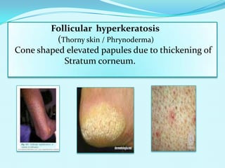 Follicular Hyperkeratosis Vitamin A Deficiency