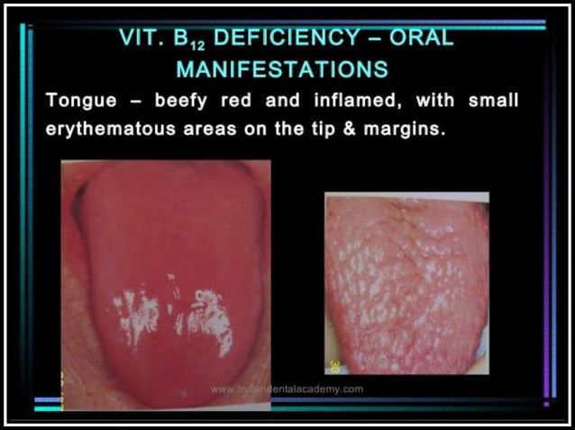 Vit b12 deficiency causes and management | PPT
