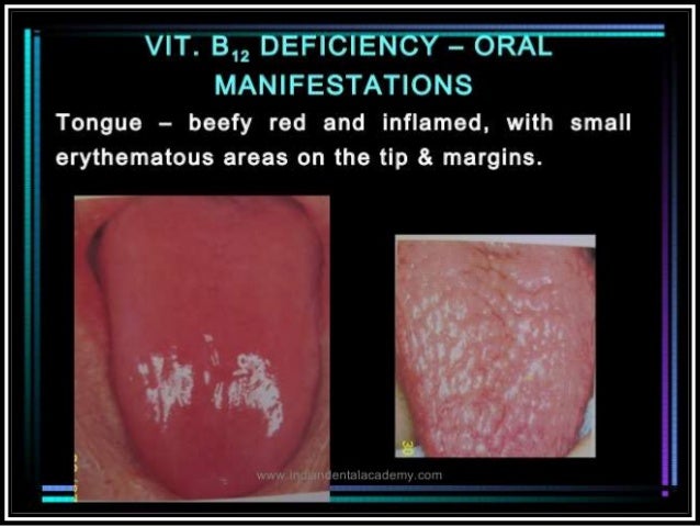 Vit b12 deficiency causes and management