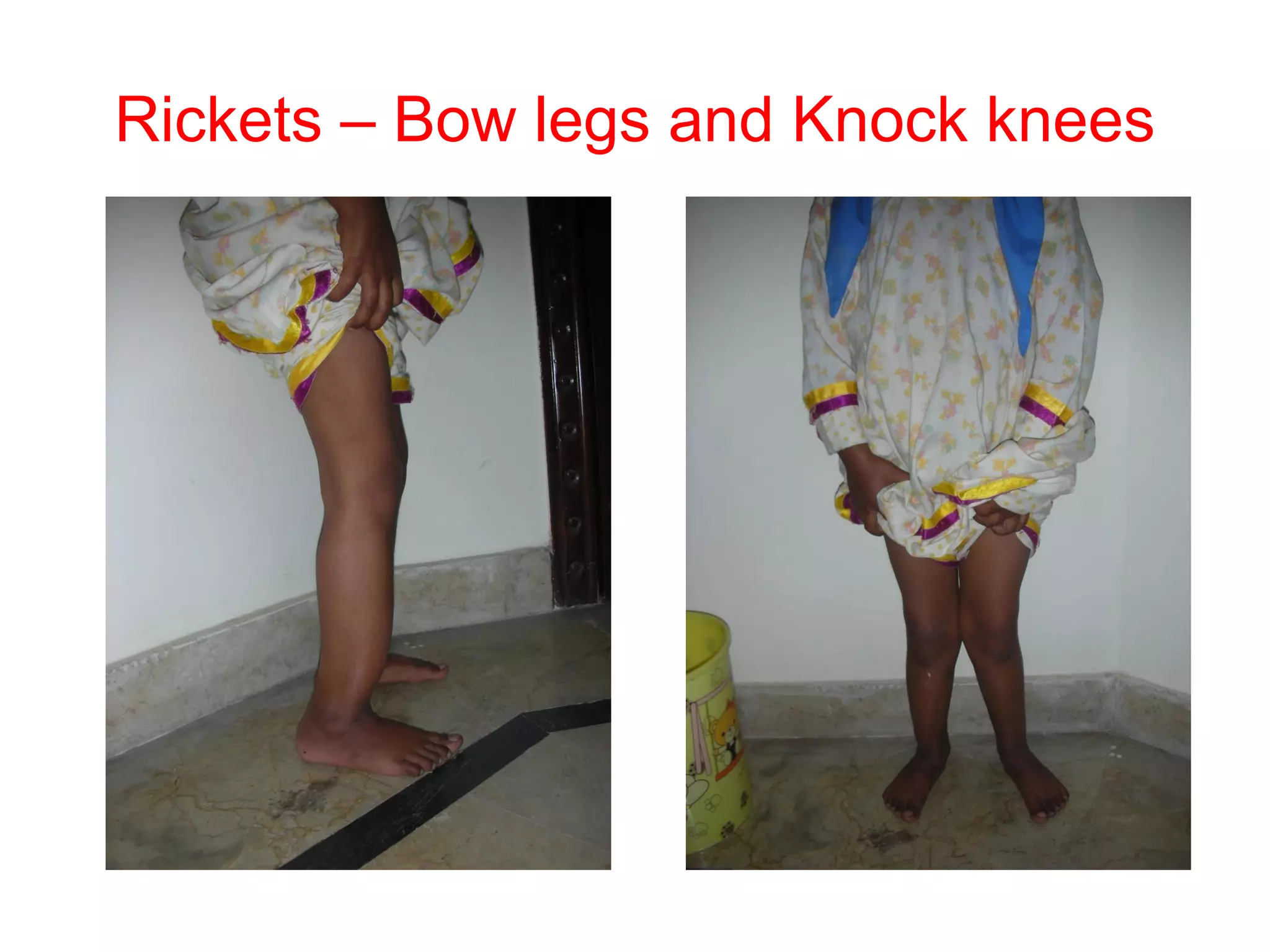 Vit d deficiency rickets 2021 | PDF