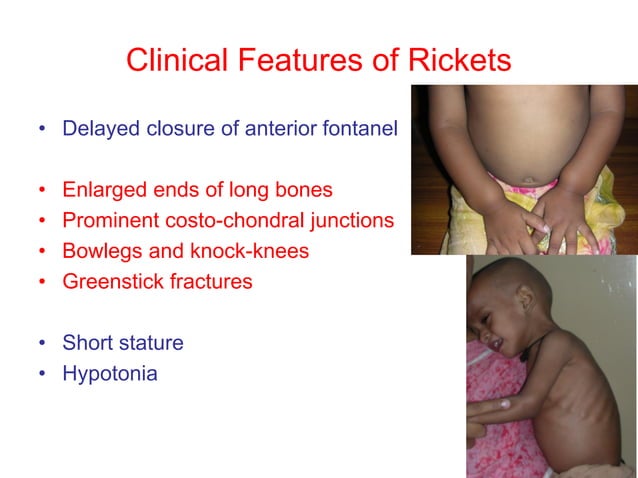 Vit d deficiency rickets 2021 | PDF