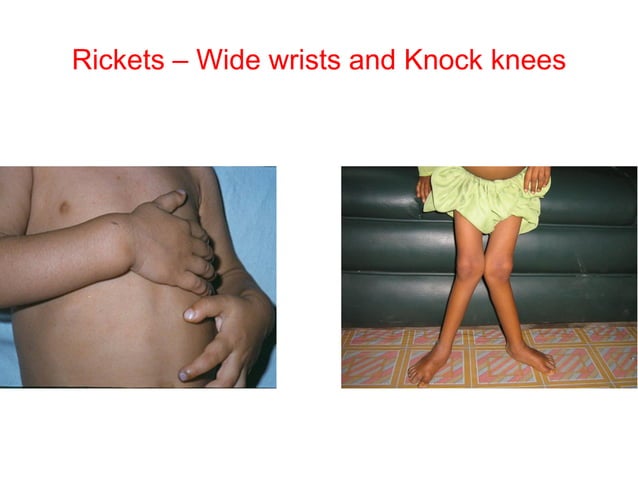 Vit d deficiency rickets 2021 | PDF