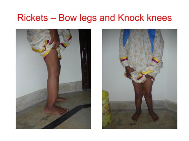 Vit d deficiency rickets 2021 | PDF