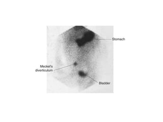 Vitello intestine duct anomalies | PPTX