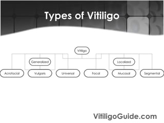 Vitiligo | PPT