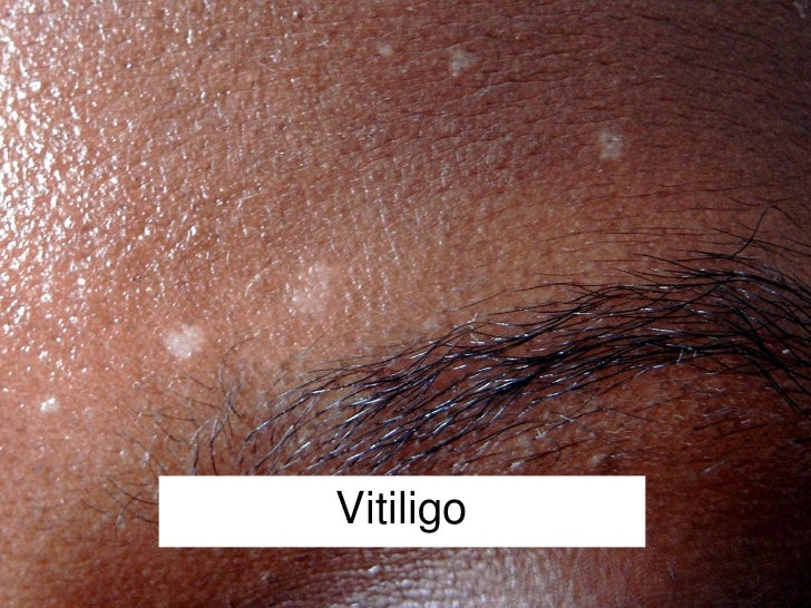 Vitiligo