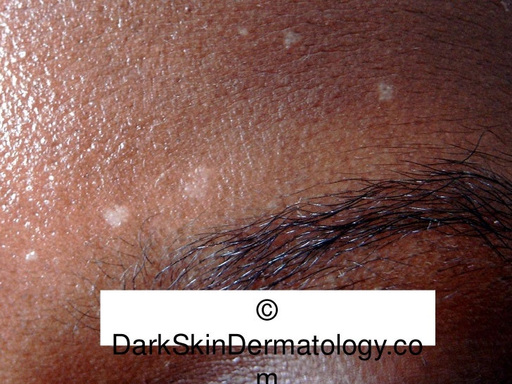 Vitiligo Cks