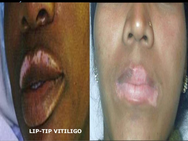Vitiligo Cks