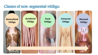 Vitiligo | PPTX