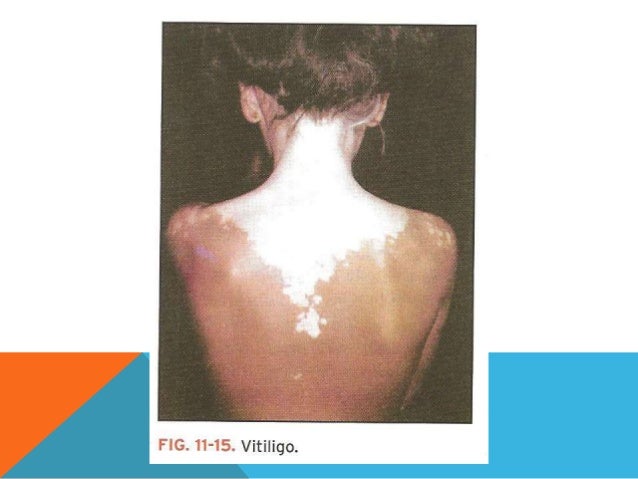 Vitiligo Cks