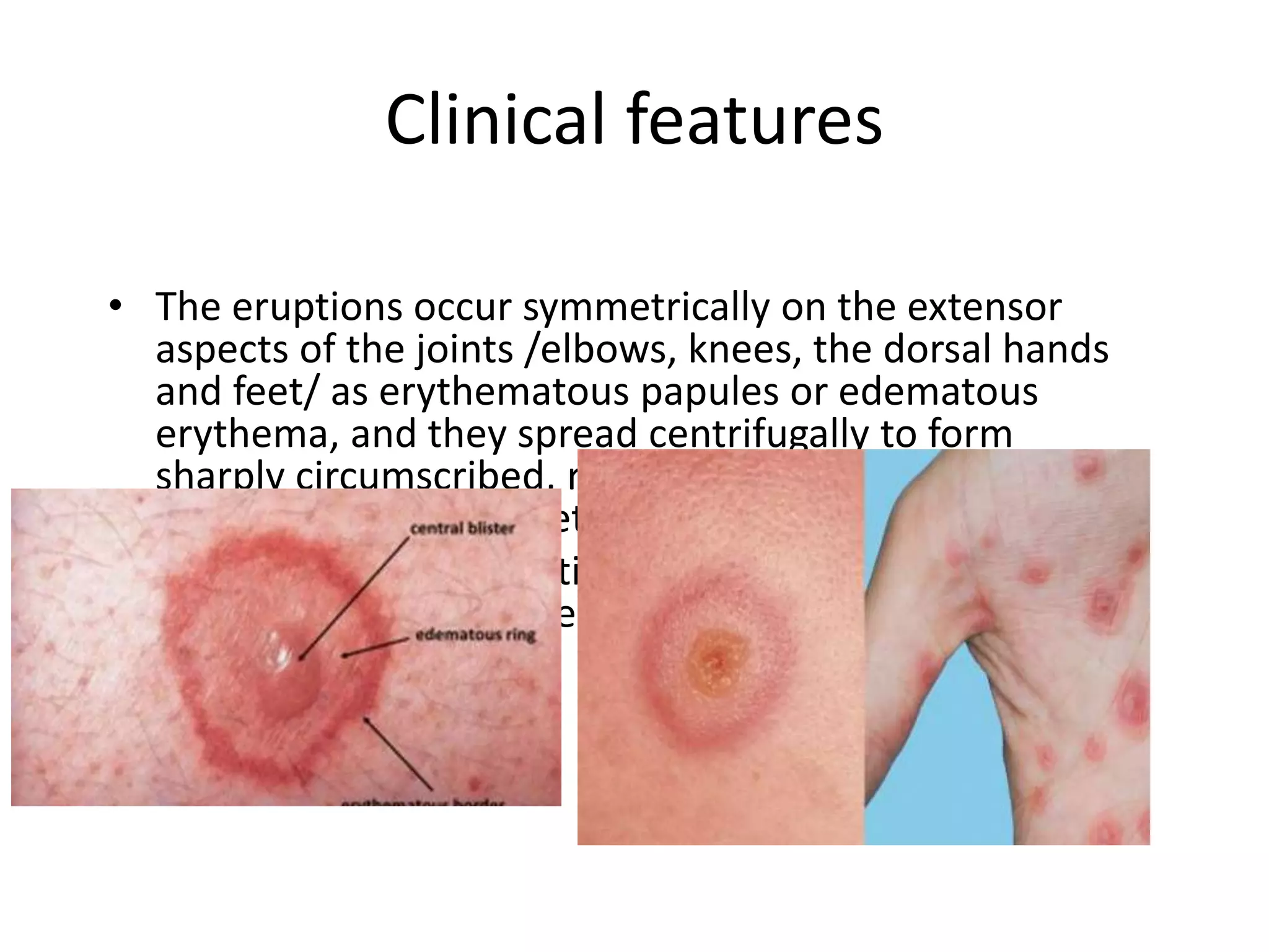 Vitiligo, Pityriasis rosea, Discoid lupus erythematosus, erythema multiforme | PPTX
