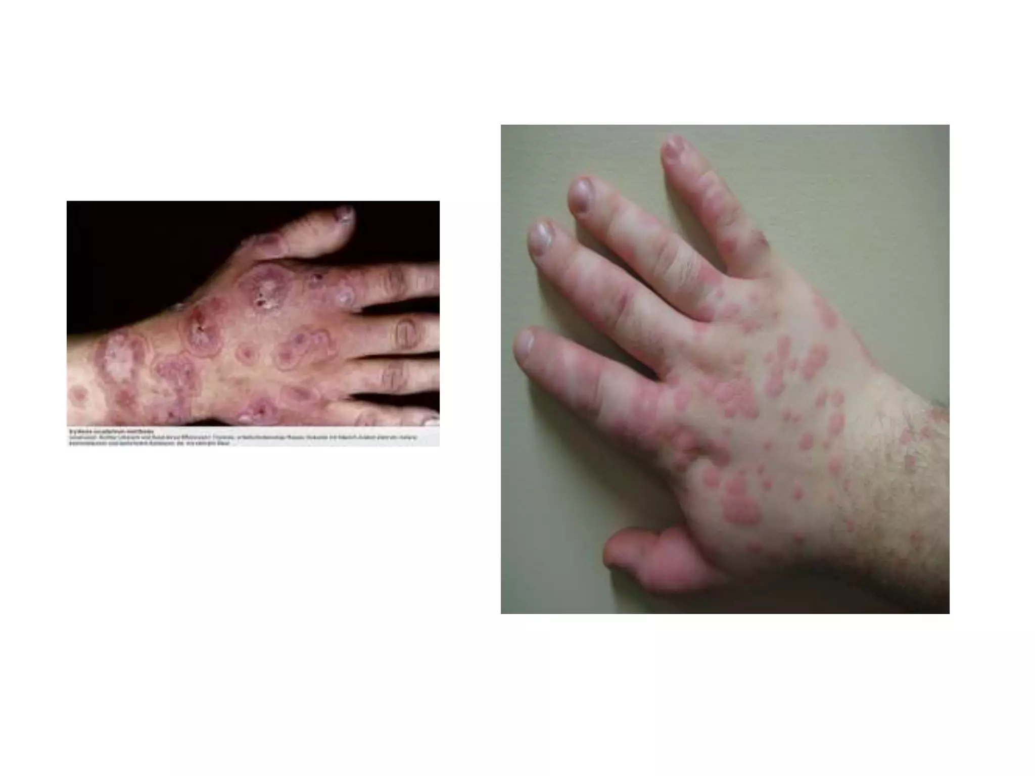 Vitiligo, Pityriasis rosea, Discoid lupus erythematosus, erythema ...