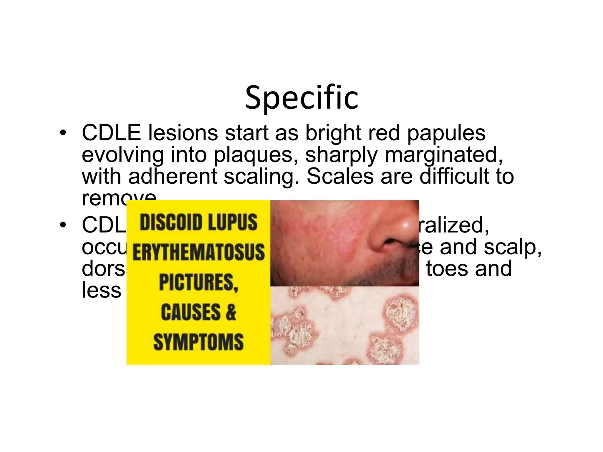 Vitiligo, Pityriasis rosea, Discoid lupus erythematosus, erythema ...