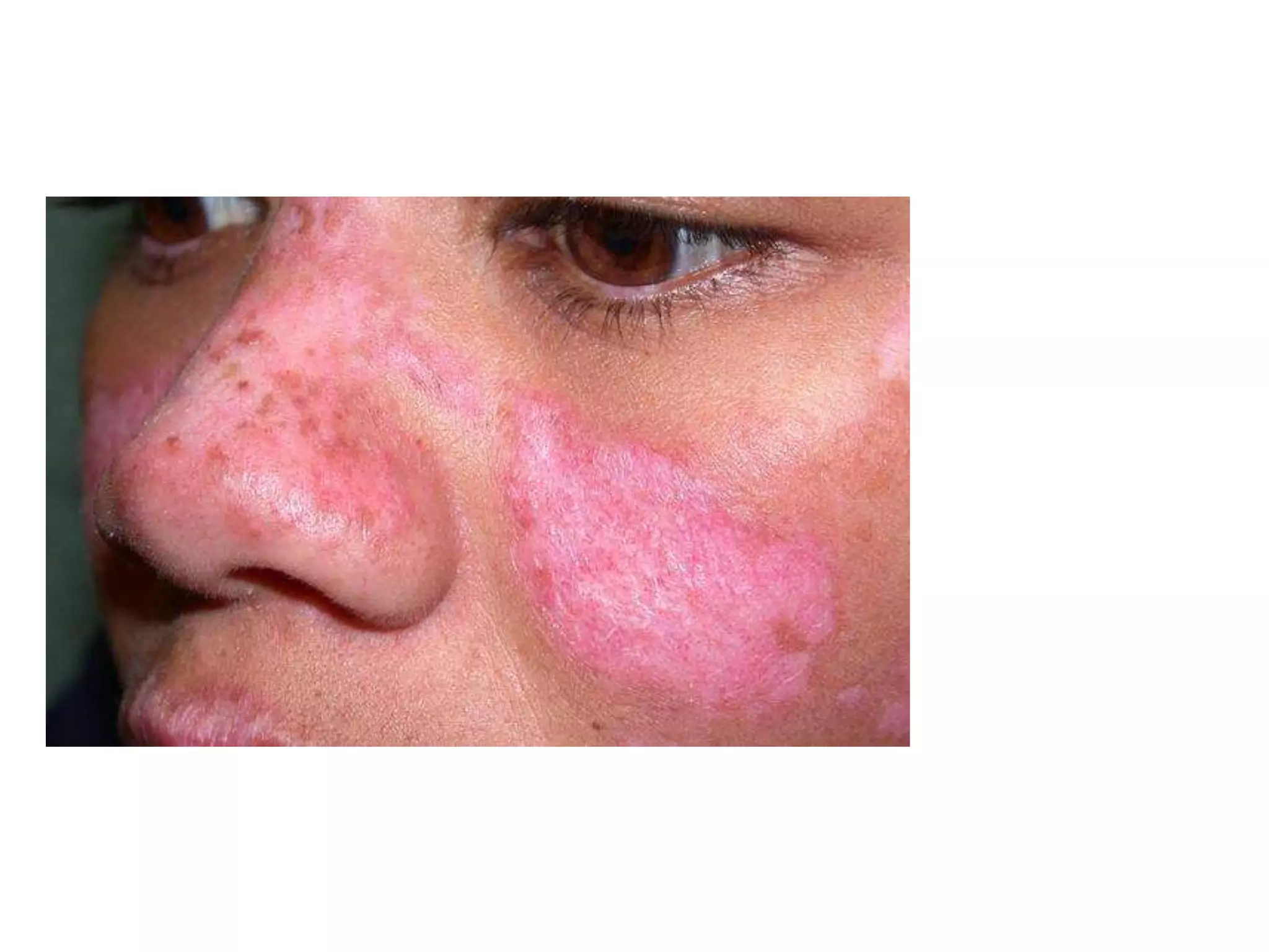 Vitiligo, Pityriasis rosea, Discoid lupus erythematosus, erythema ...