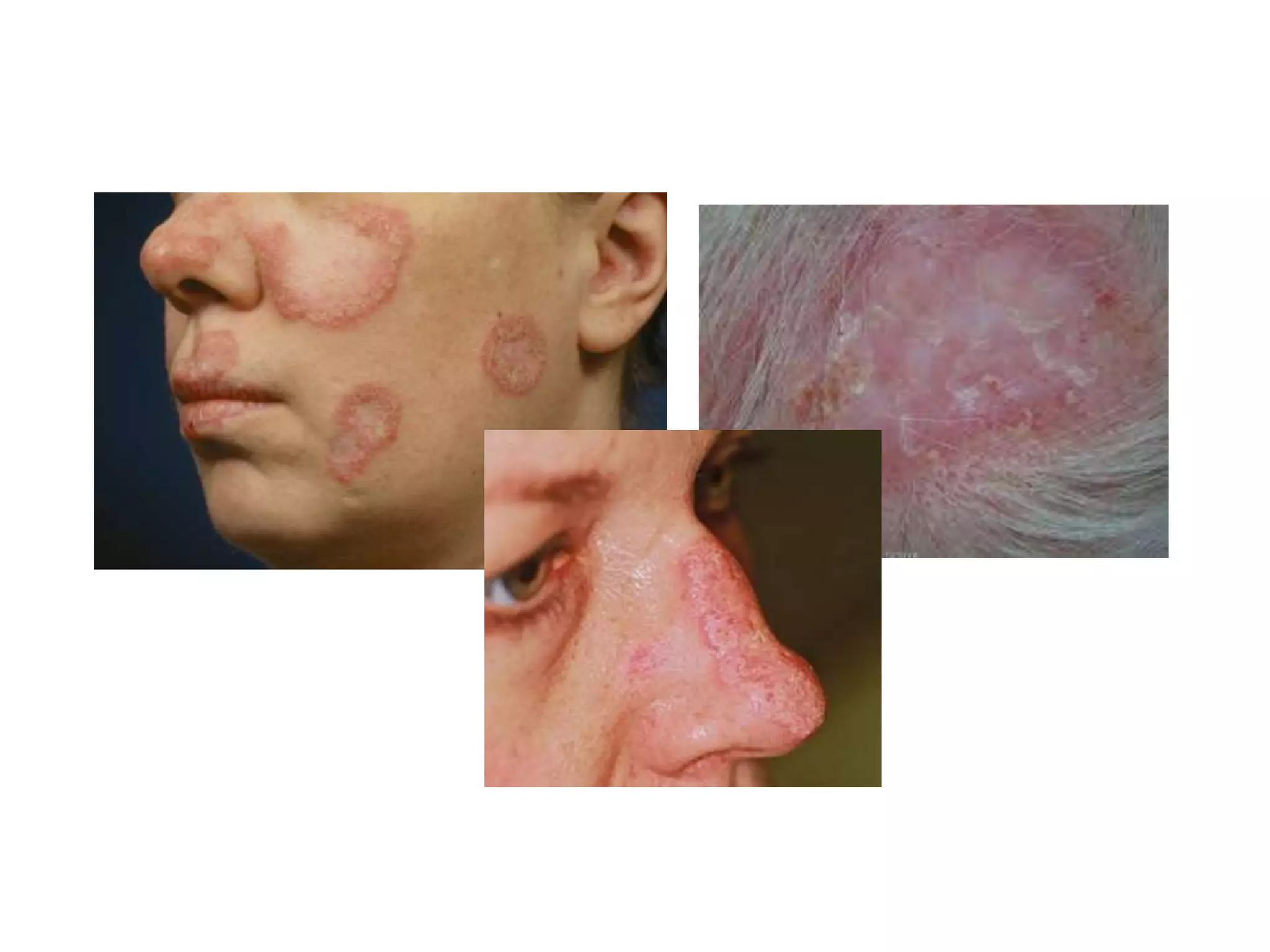 Vitiligo, Pityriasis rosea, Discoid lupus erythematosus, erythema ...