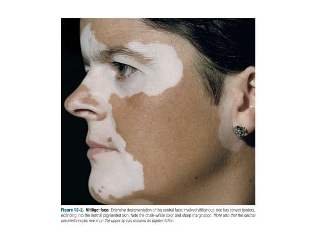 Vitiligo, Pityriasis rosea, Discoid lupus erythematosus, erythema ...